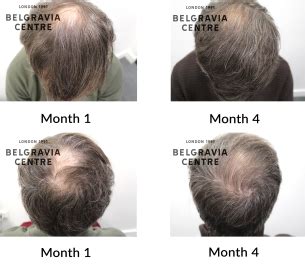 Hair Loss Success Story An Easy Treatment Process