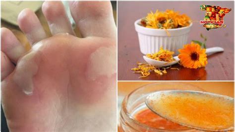Cómo curar las ampollas de los pies usando 5 soluciones caseras YouTube
