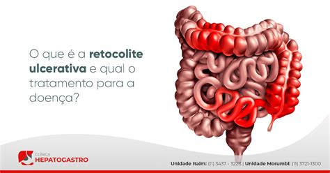 O Que é A Retocolite Ulcerativa E Qual O Tratamento Para A Doença