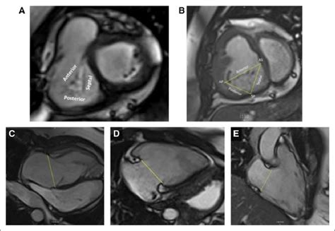 Cine Steady State Free Precession SSFP Images Showing The Tricuspid