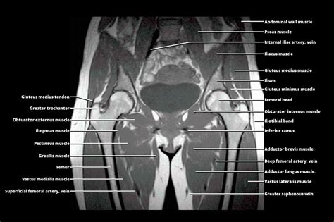 Mri Of Pelvis