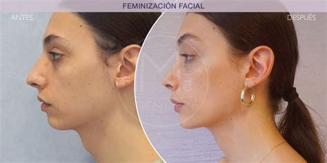 Lifting Facial Feminizante Clínica IM GENDER