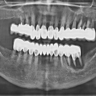 Panoramic X Ray Showing Bone Loss Around The Natural Teeth For A