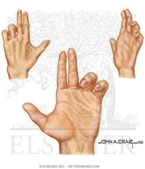 Hand Of Benediction Median Nerve Injury MEDizzy