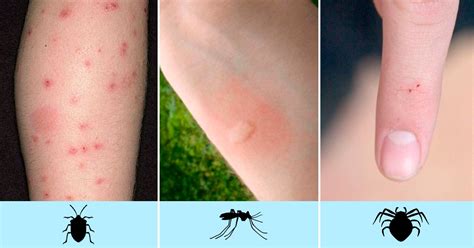 8 picadas de insetos para identificar e saber como tratá las Maisvibes