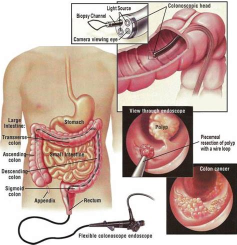 Colonoscopy