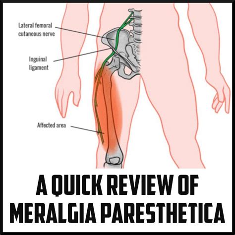 Meralgia Paresthetica Causes Symptoms And Treatments Ejercicios Porn