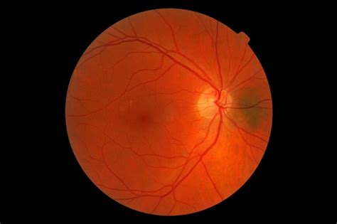 Diyabetik Retinopati için Homeopati Tedavisi Homeopati Türkiye