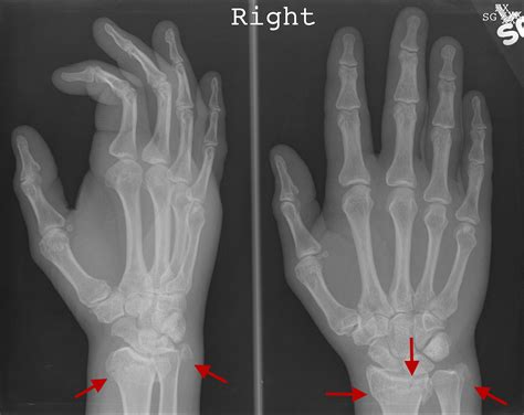 Avulsion Fracture Of Styloid Process Of Ulna