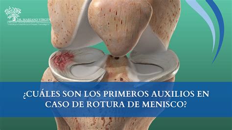 Cuáles son los primeros auxilios en caso de rotura de menisco Dr