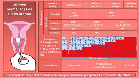 Lesiones Premalignas De Cervix LSIL HSIL LIEBG LIEAG Neoplasia