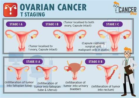 Ovarian Cancer Staging Surgery For Ovarian Cancer Principles And
