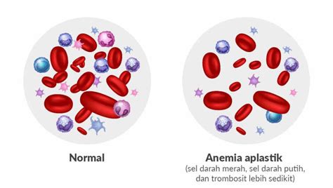 Mengenal Penyakit Langka Anemia Aplastik Yang Diderita Babe Cabita