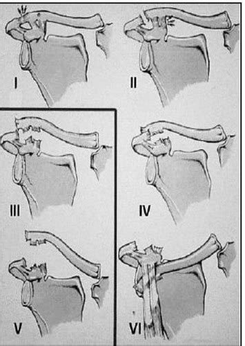 Uch Obere Extremit T Schulter Klavikula Oberarm Flashcards