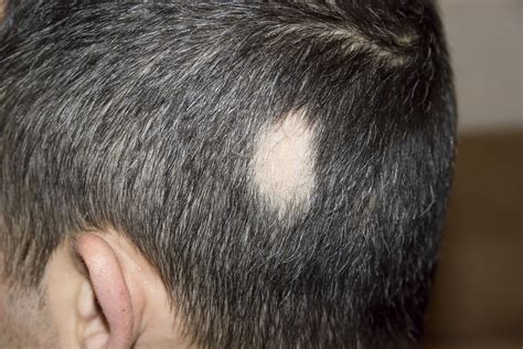 Alopecia Areata Symptoms Causes Treatment Tua Sa De