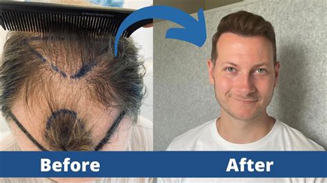 Le parcours du patient Freidemann pour sa greffe de cheveux Résultats