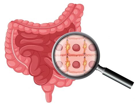 Divertículos y Diverticulitis Entendiendo las causas síntomas y