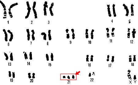 Chromosome Banding Definition Types Importance Video Lesson