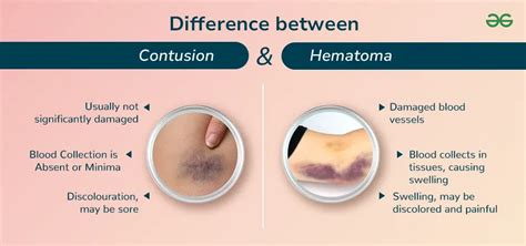 Difference Between Contusion And Hematoma Geeksforgeeks