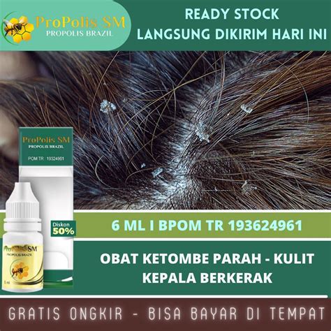 Jual Obat Ketombe Parah Borok Di Kepala Kulit Kepala Berkerak