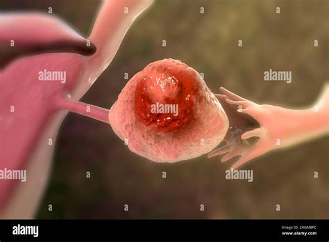 Karzinom Fotos und Bildmaterial in hoher Auflösung Alamy