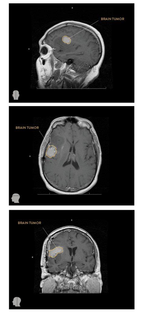 Cat Scan Brain Tumor