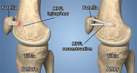 Combined Medial Patellofemoral Ligament Medial Quadriceps 54 OFF