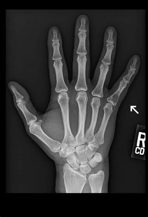 Broken Pinky Finger X Ray