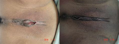 Labiaplasty Feel Comfortable And Confident In Your Own Body