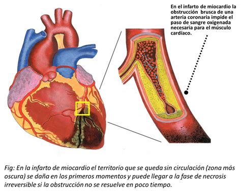 Qué es el infarto agudo de miocardio