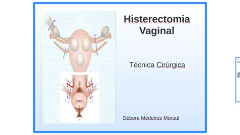 Histerectomia Vaginal By Guilherme Araujo Silva On Prezi