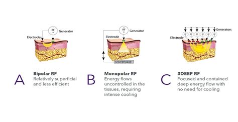 Endymed Deep Skin Tightening As Laser Clinic