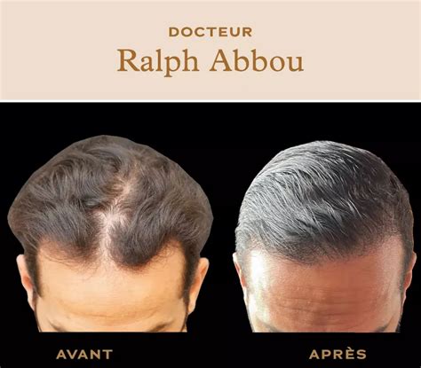 Greffe De Cheveux Paris Technique Fue Et Fut Dr Ralph Abbou