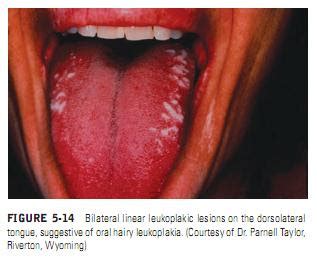 Burkets Oral Medicine Infectious White Lesions And White And Red