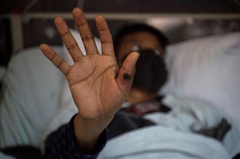 Kasus Cacar Monyet Di Jakarta Jadi 39 Orang 22 Orang Masih Diisolasi