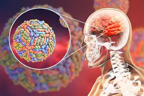 Infectia Cu Virusul West Nile Transmitere Manifestari Si Optiuni De