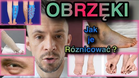 Obrzęki żylne limfatyczne tłuszczowe Jak je rozpoznać Jak je leczyć