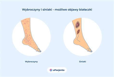 Białaczka objawy rodzaje diagnostyka uPacjenta