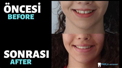 Ortodonti Tedavisi Sonuçları Diş Teli Tedavisi Önce Sonra YouTube