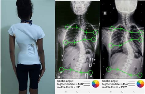 Colete Ortopédico 3D para Escoliose Movimento Centro de Terapias e Cursos