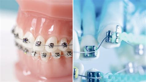 Brackets Met Licos Todo Lo Que Debes Saber En