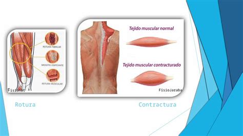 PPTX Lesiones Del Aparato Locomotor DOKUMEN TIPS