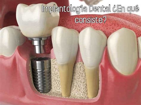 Implantología Dental Qué Es y Cómo Se Realiza George Washington