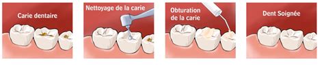 cabinet dentaire Rhône 69 Les soins de caries