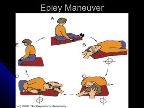 Epley Maneuver For Vertigo In Spanish Pdf Resspig