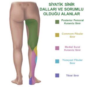 Siyatik Lumbago Siyatik Kad K Y Fizik Tedavi