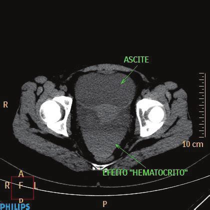 Corte axial Líquido mais denso em fundo de saco caracterizando o