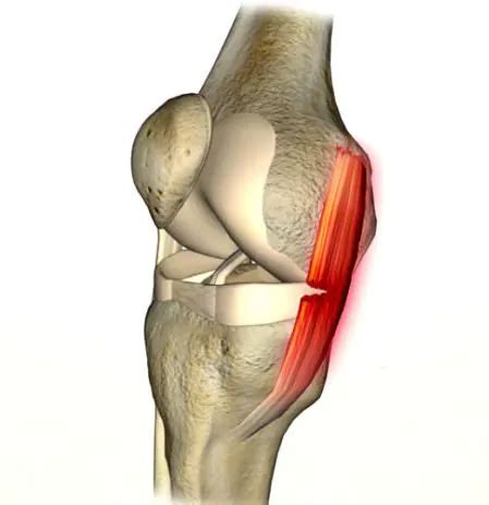 Recuperação do ligamento colateral lateral na musculação Personal