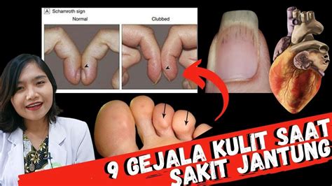 9 TANDA PADA KULIT SAAT SAKIT JANTUNG Dr Emasuperr YouTube