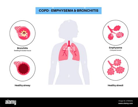 Chronic Obstructive Pulmonary Disease Illustration Stock Photo Alamy